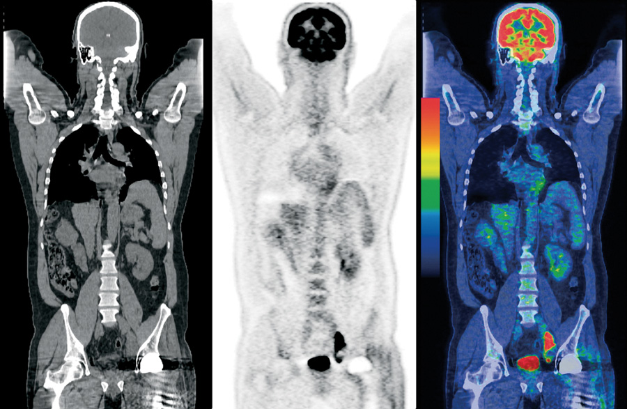 Pet CT Pet Scan Cl nica Mult Imagem Pet CT Pet Scan Cl nica Mult Imagem